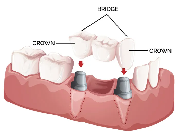 A Guide to Dental Bridge and its Benefits - India Dental Tourism